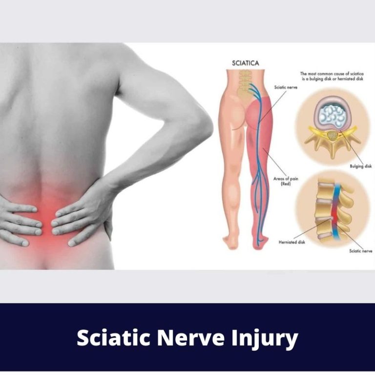 Sciatic Nerve Injury – Abotare Clinic
